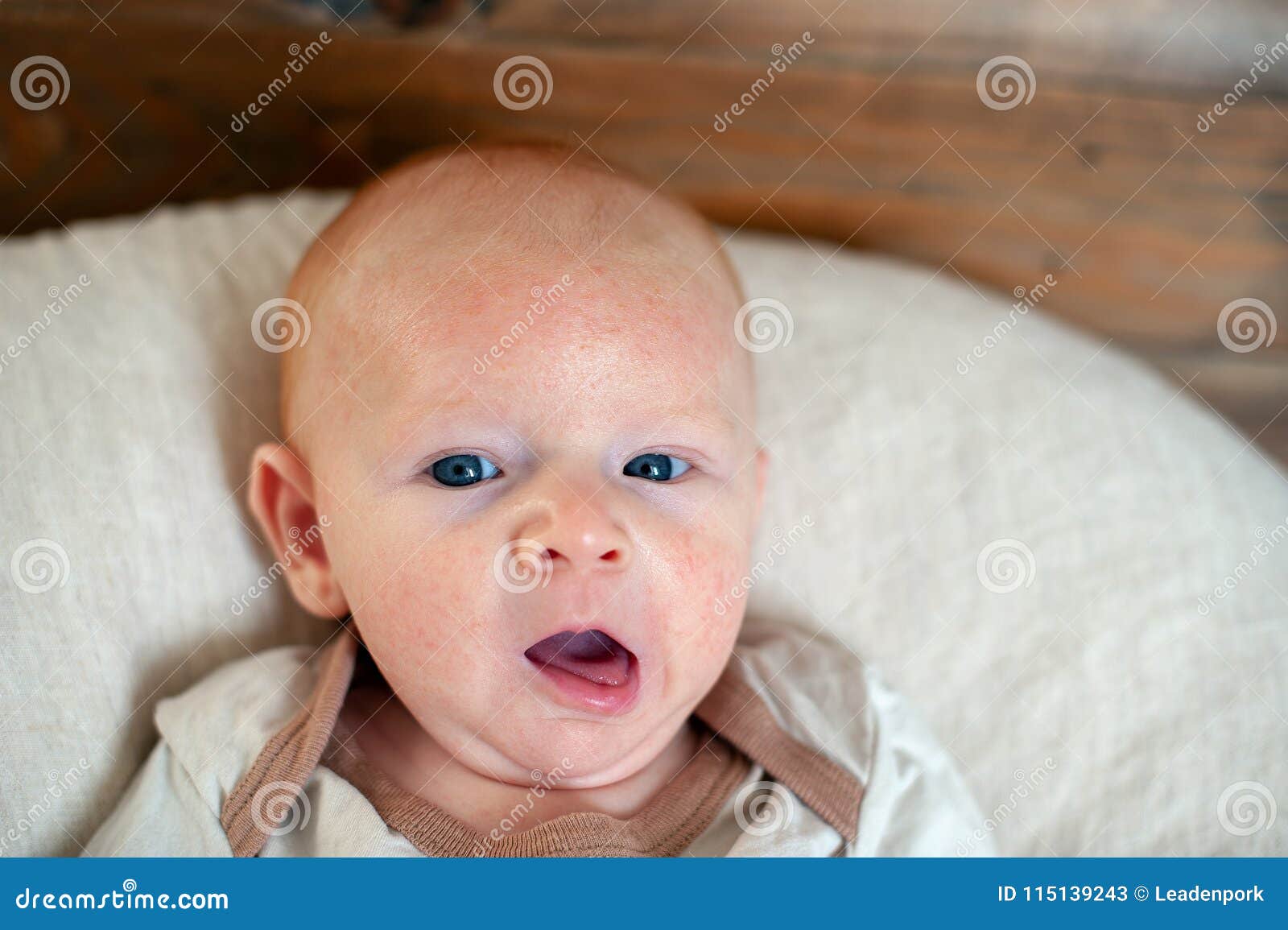 Allergies, Atopic Dermatitis on the Face Stock Image - Image of ecdysis ...