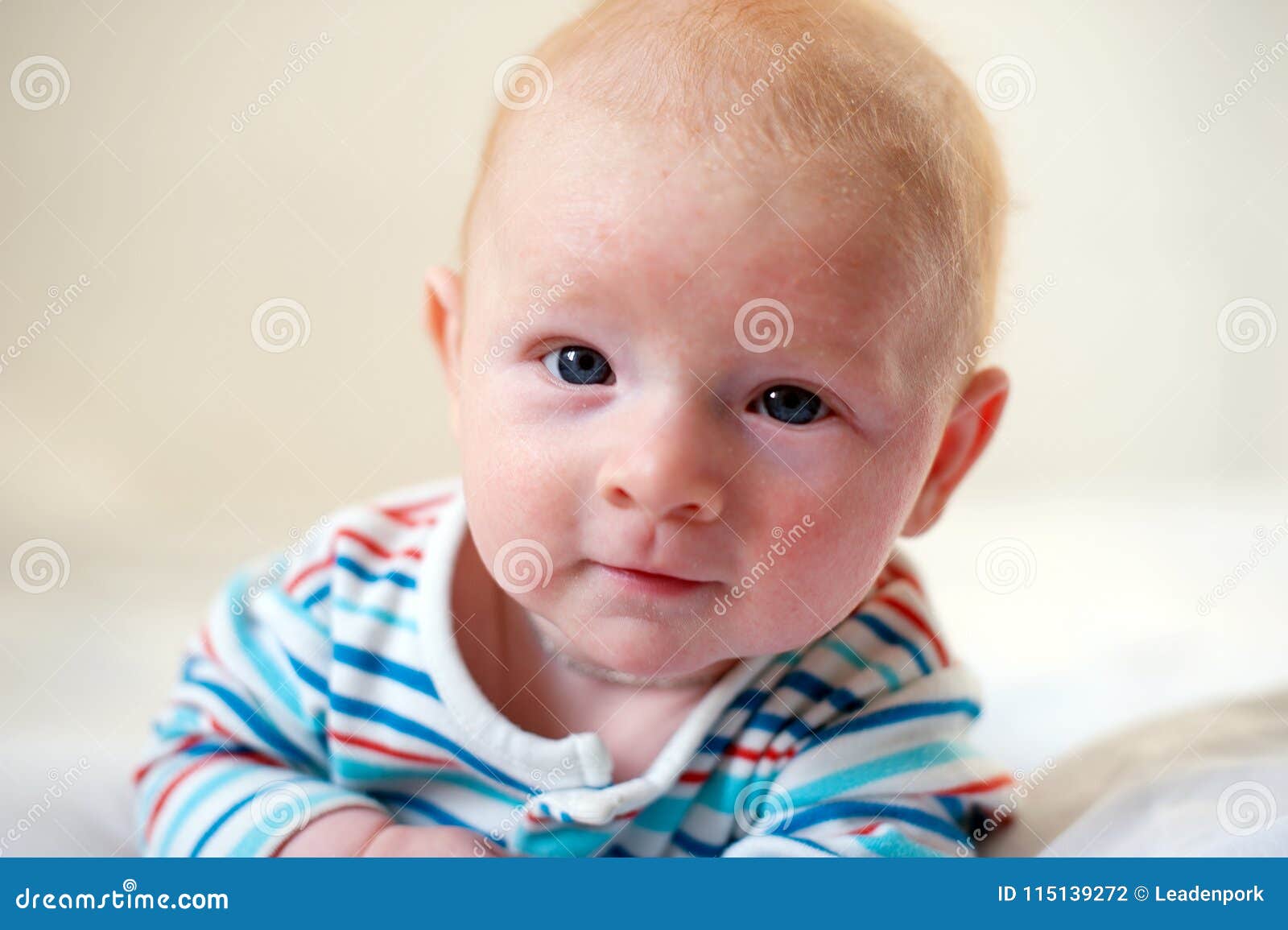 Allergies, Atopic Dermatitis on the Face Stock Photo - Image of male ...