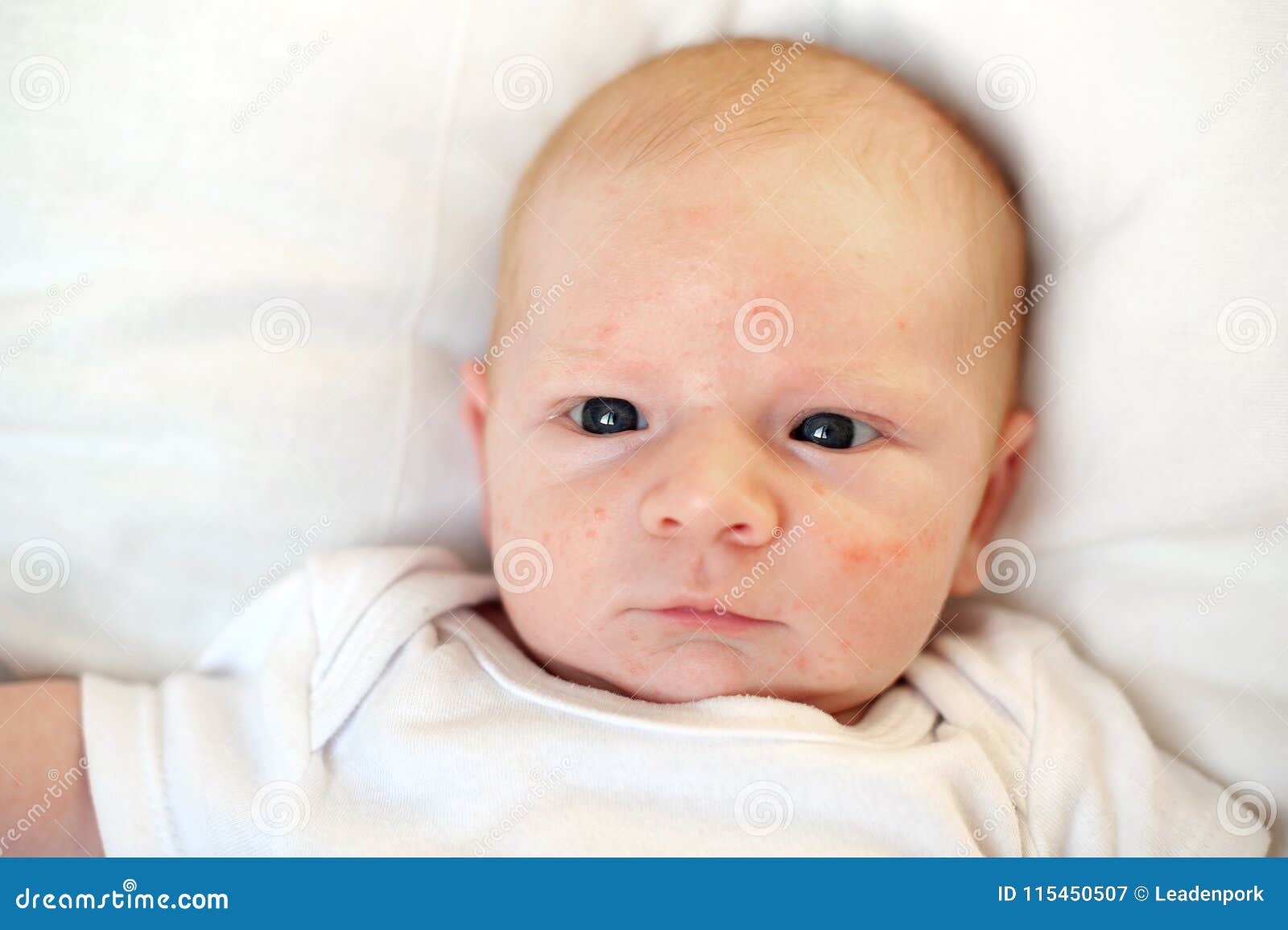 Allergies, Atopic Dermatitis on the Face Stock Image - Image of ...