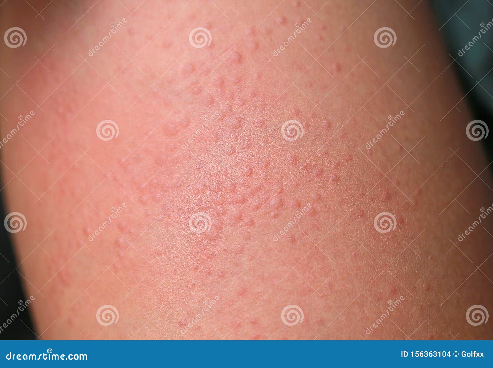 Allergische Huiduitslag, Eczeem Op De Huid Stock Foto - Image of sluit ...