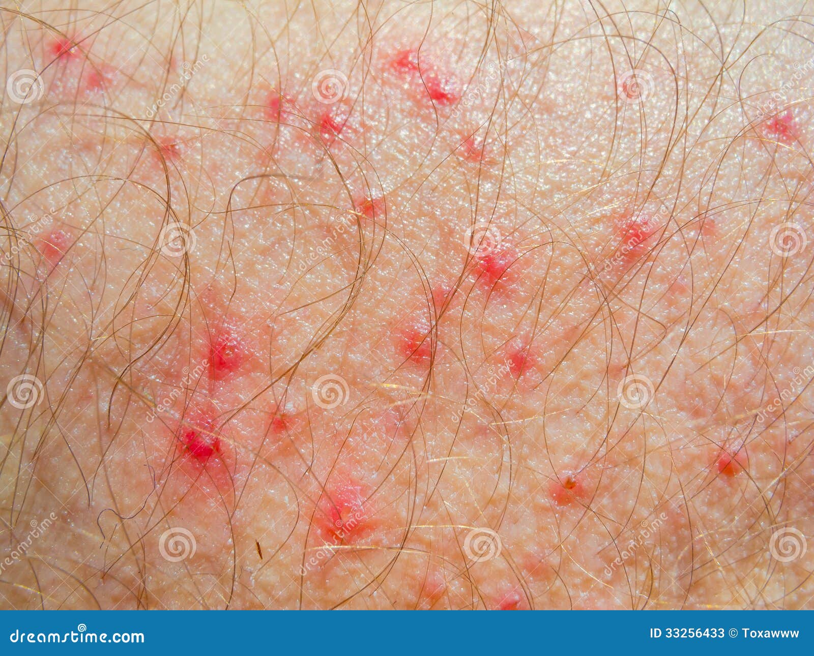 Allergische Reaktion stockbild. Bild von krankheit, hautentzündung ...