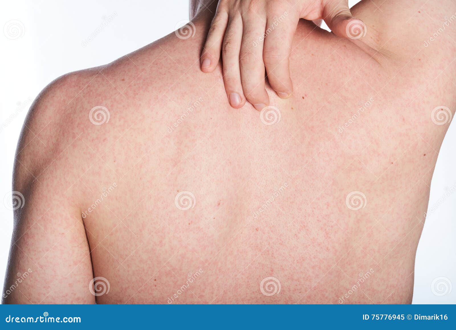Allergy on back of man stock image. Image of treatment - 75776945
