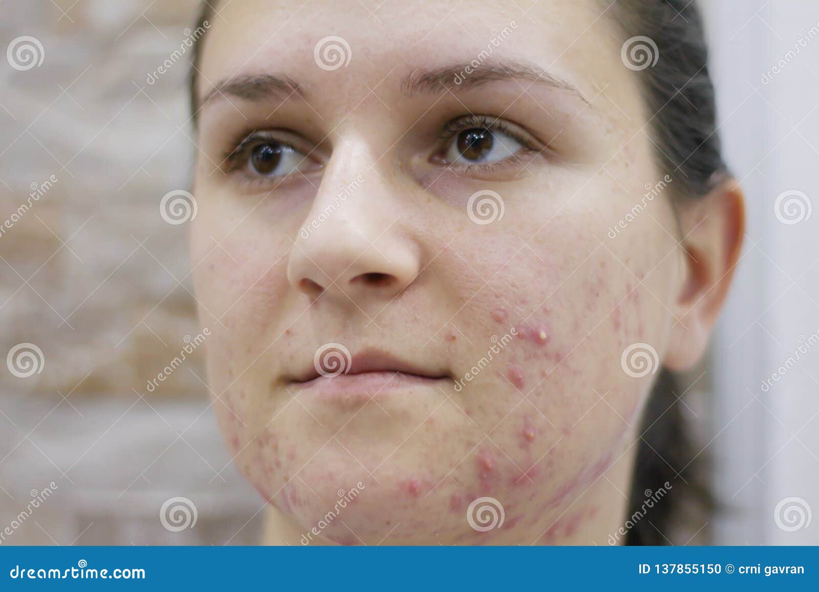 Allergy Concept,young Girl with Problematic Pimple on the Face.-image ...