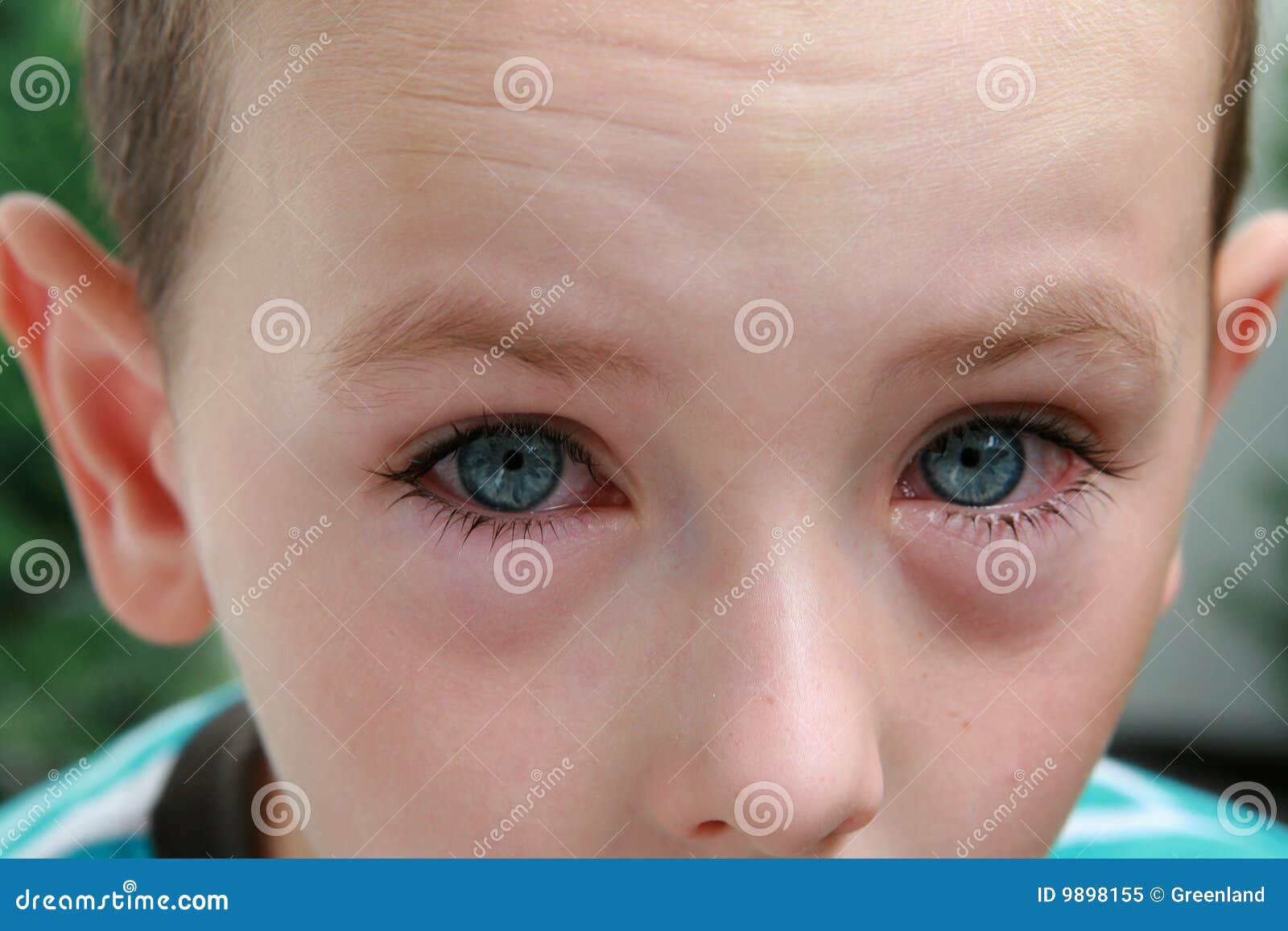 Allergy and conjunctivitis stock image. Image of baby - 9898155