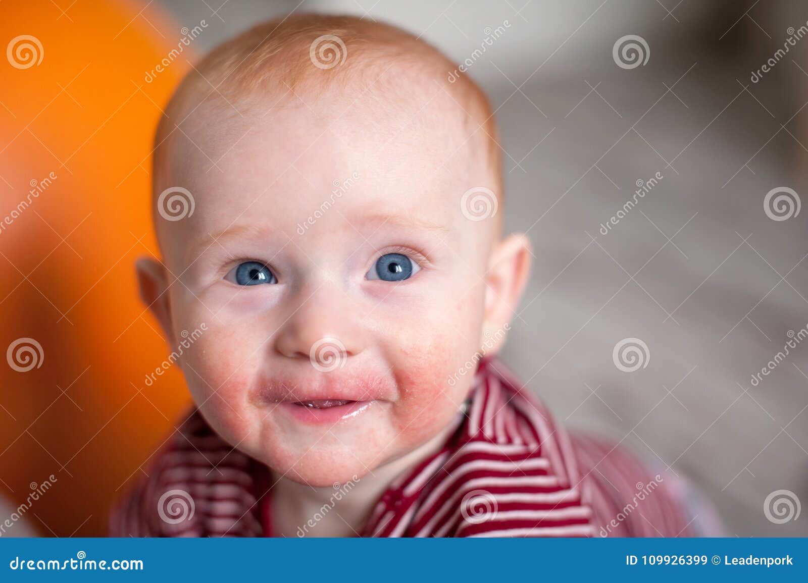 Allergy on the face stock image. Image of dermatitis - 109926399