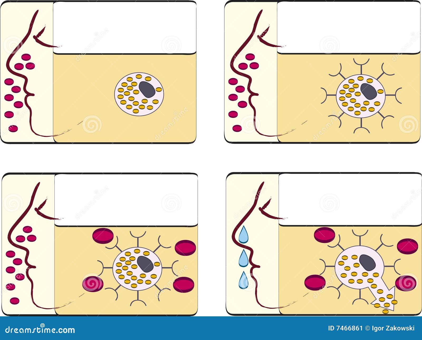 Allergy hay fever stock vector. Illustration of medical - 7466861