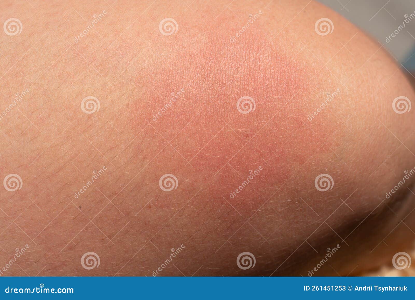 Bee Sting. Bee Sting In Human Skin. Consequences Of Stinging With Bee ...