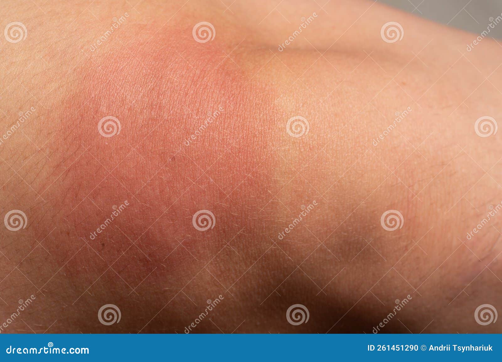 Bee Sting. Bee Sting In Human Skin. Consequences Of Stinging With Bee ...
