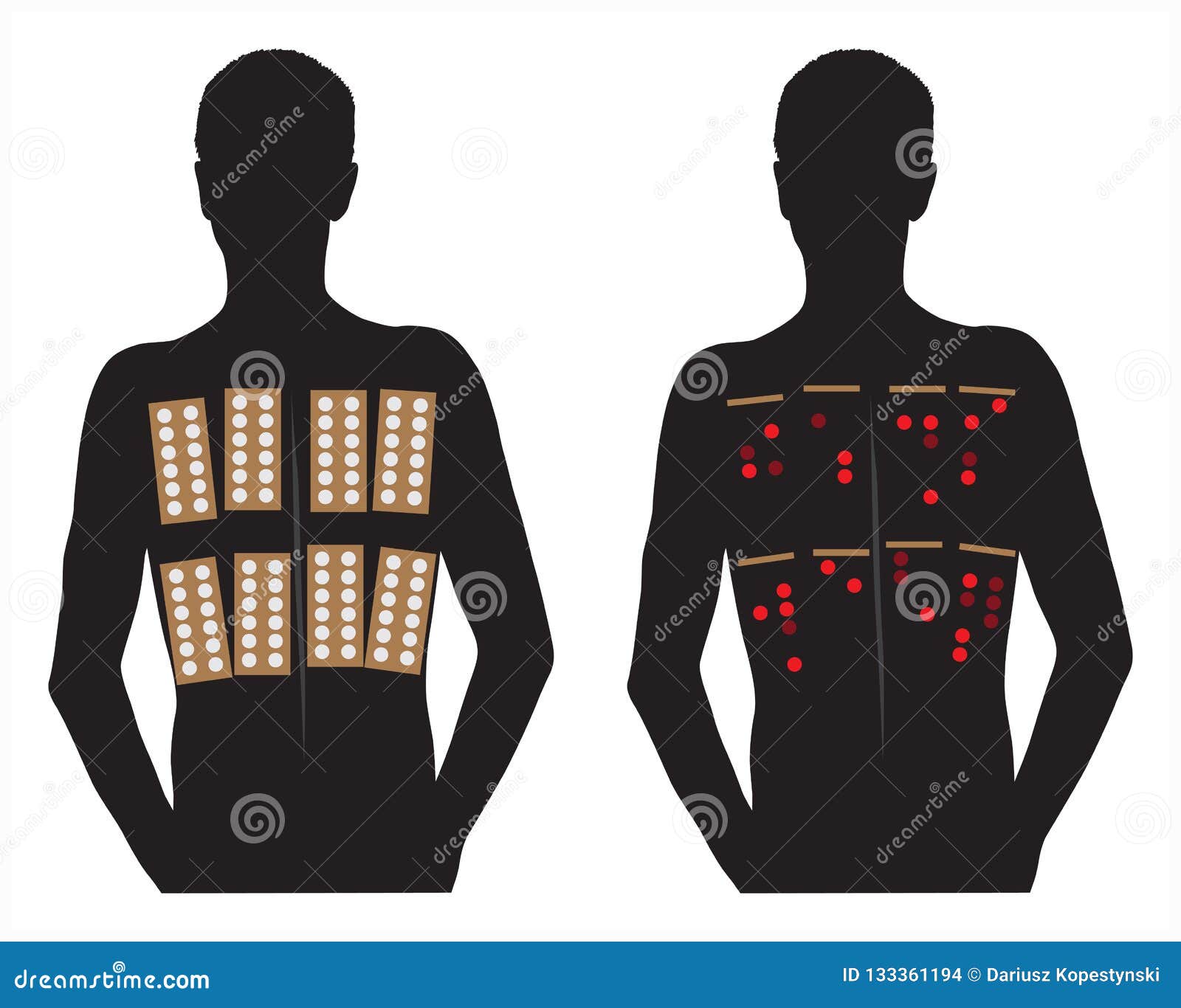 Allergy Patch Skin Tests Vector Illustration | CartoonDealer.com #133361194