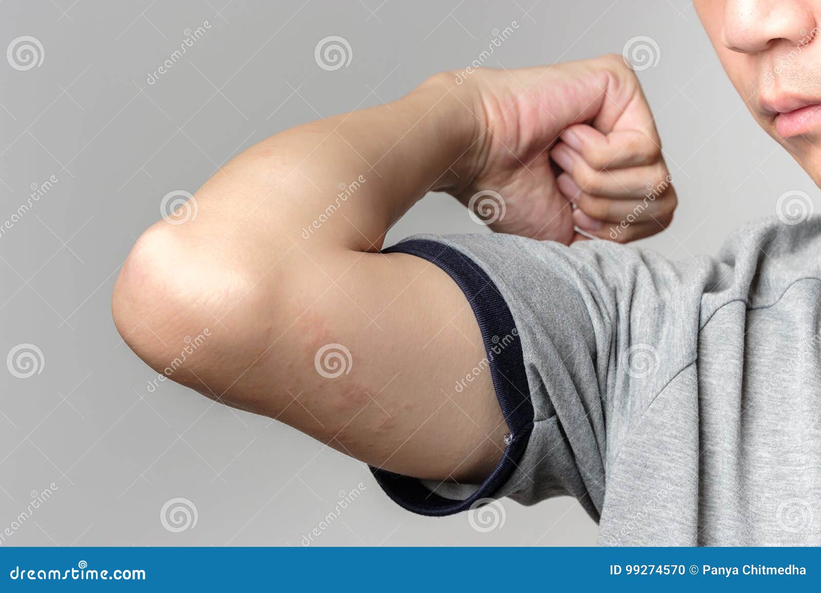 Allergy rash stock photo. Image of psoriasis, caucasian - 99274570