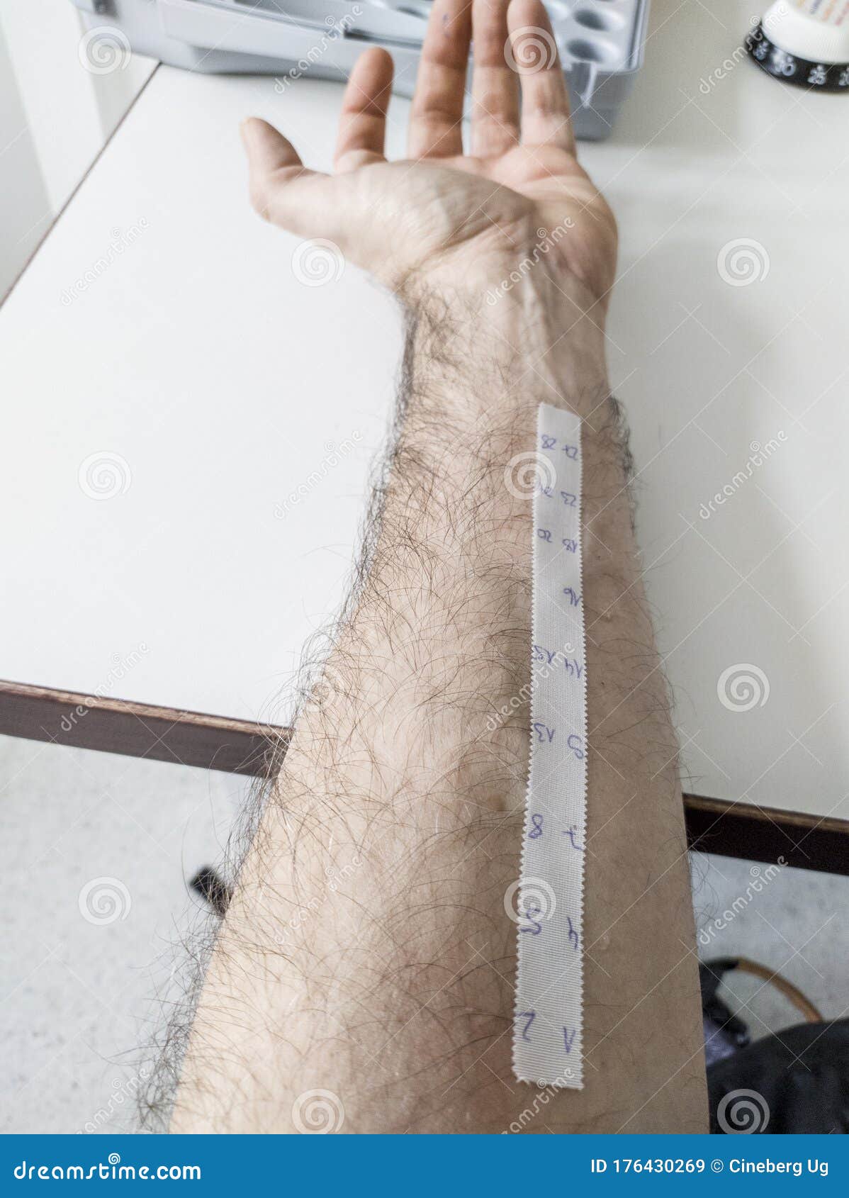 Allergy scratch test stock image. Image of experiment - 176430269