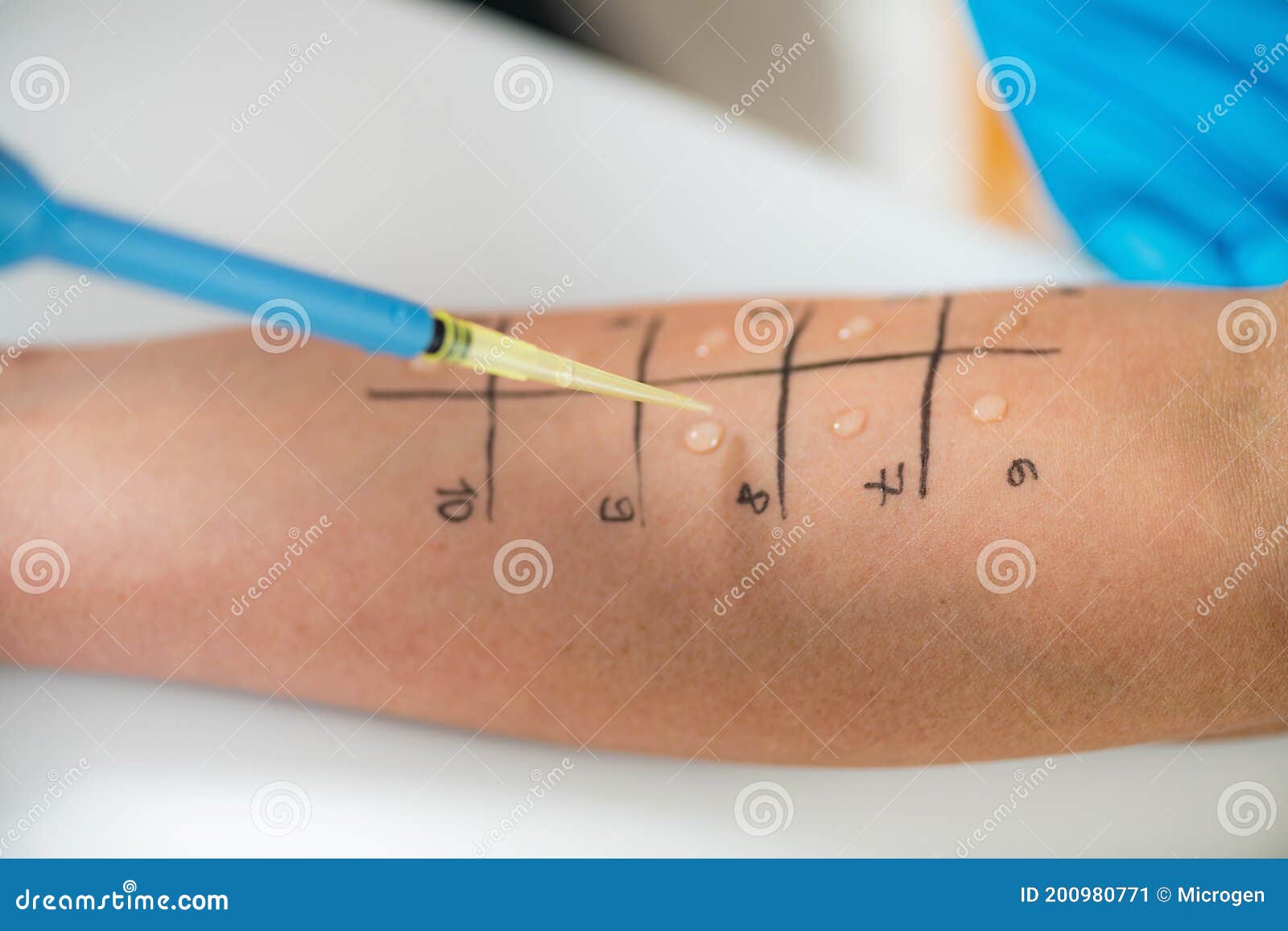 Allergy - Skin Testing stock image. Image of allergenic - 200980771