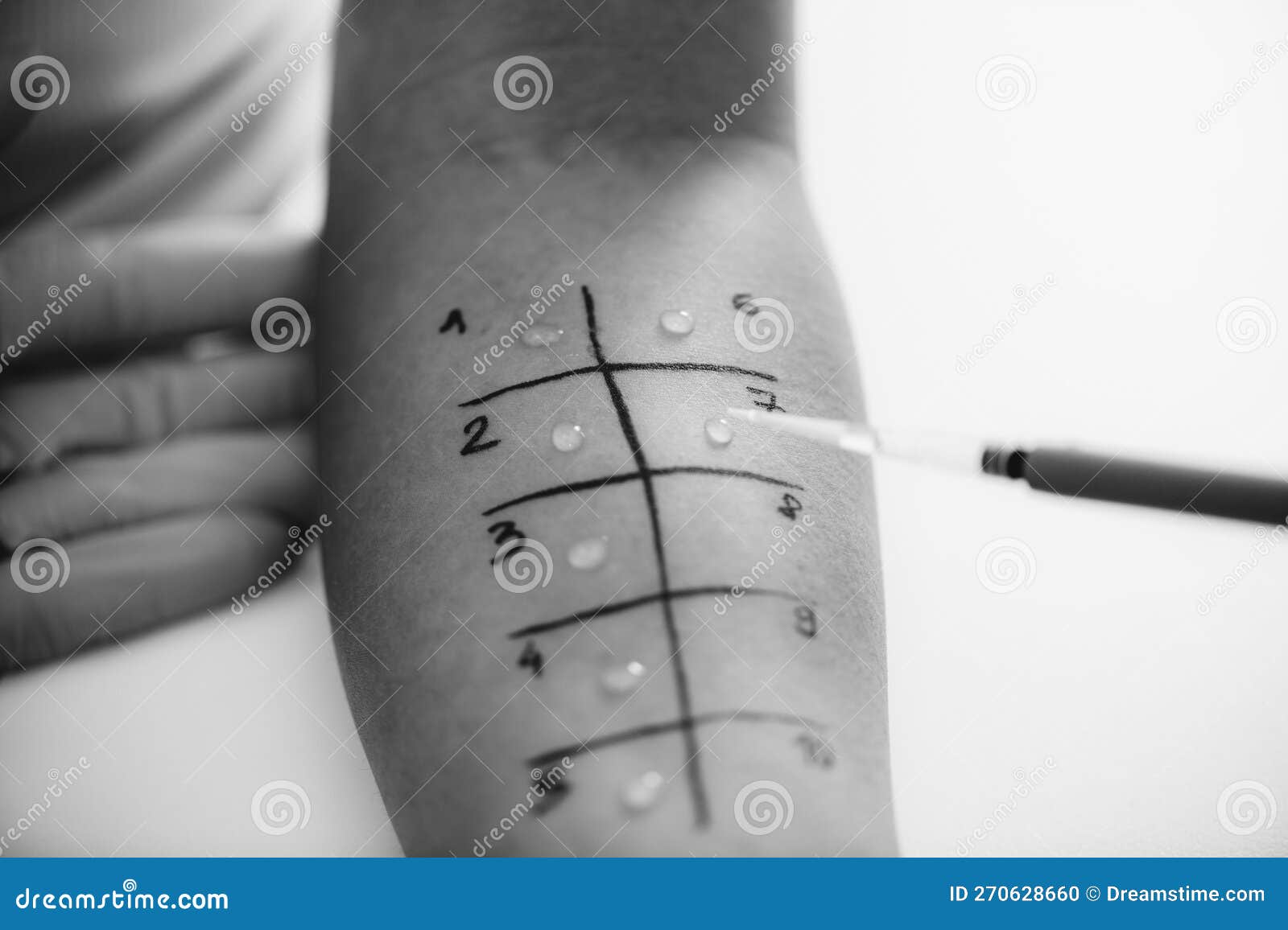 Allergy - Skin Testing stock photo. Image of procedure - 270628660