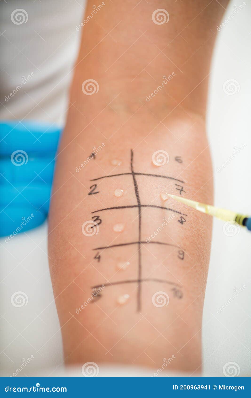 Allergy - Skin Testing stock image. Image of examination - 200963941