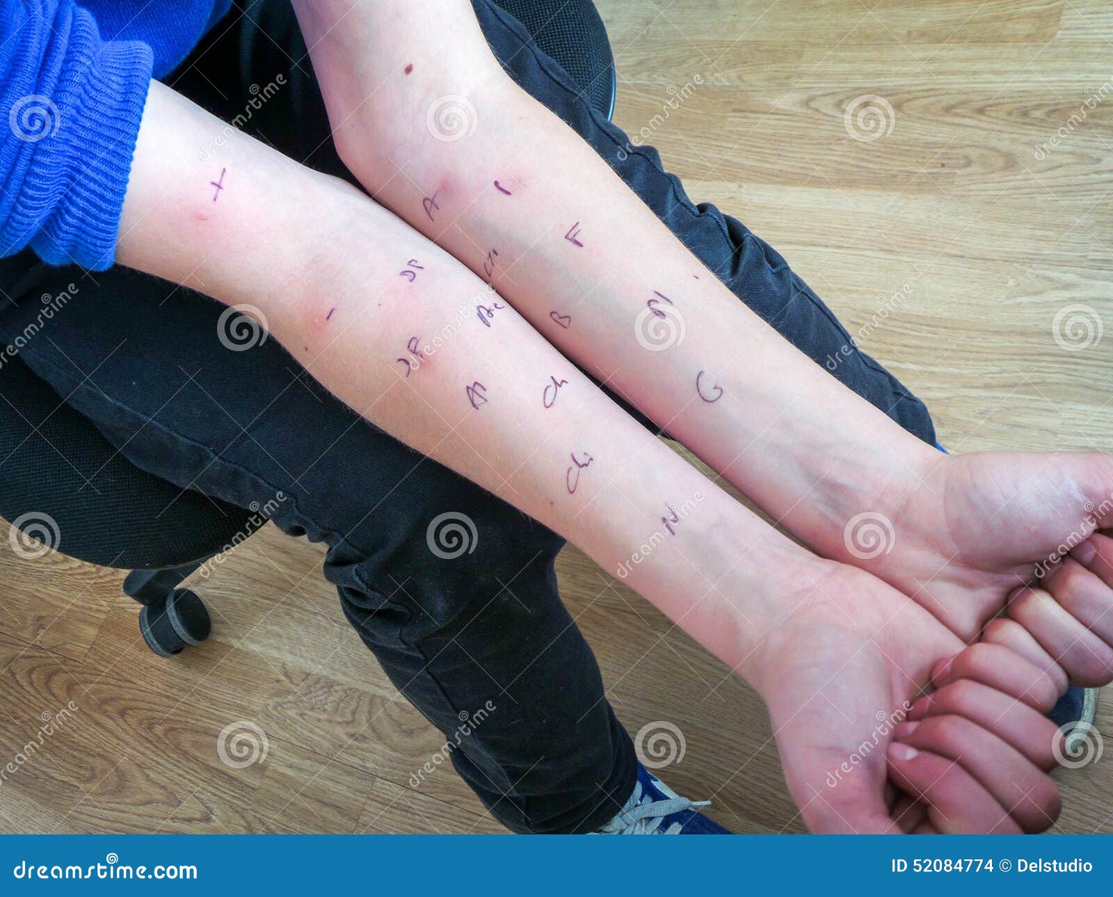 Allergy skin test stock photo. Image of allergist, care - 52084774