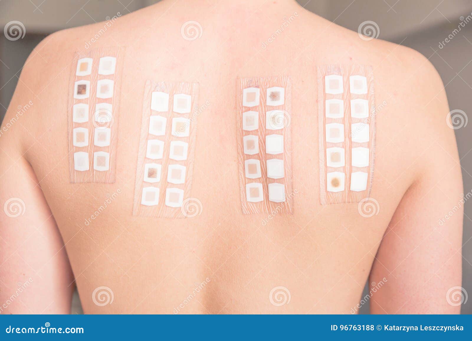 Allergy test stock photo. Image of color, human, caucasian - 96763188