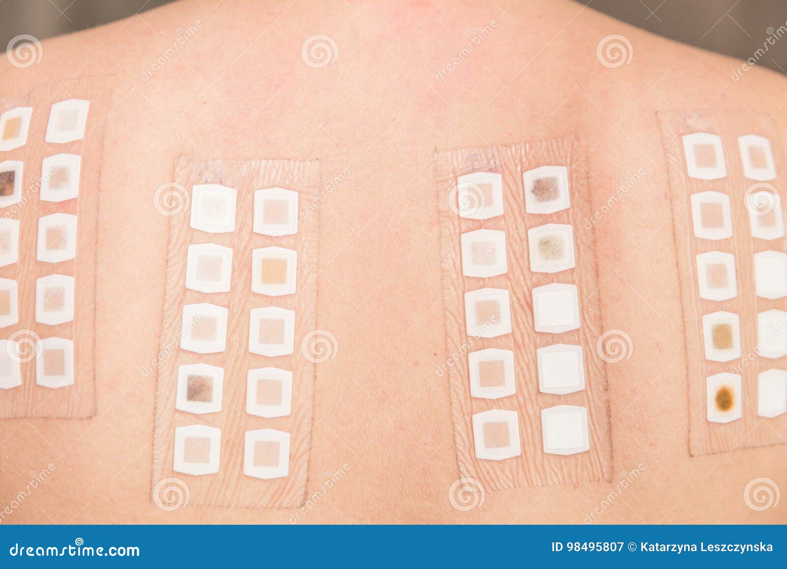 Allergy test stock image. Image of caucasian, skin, allergy - 98495807