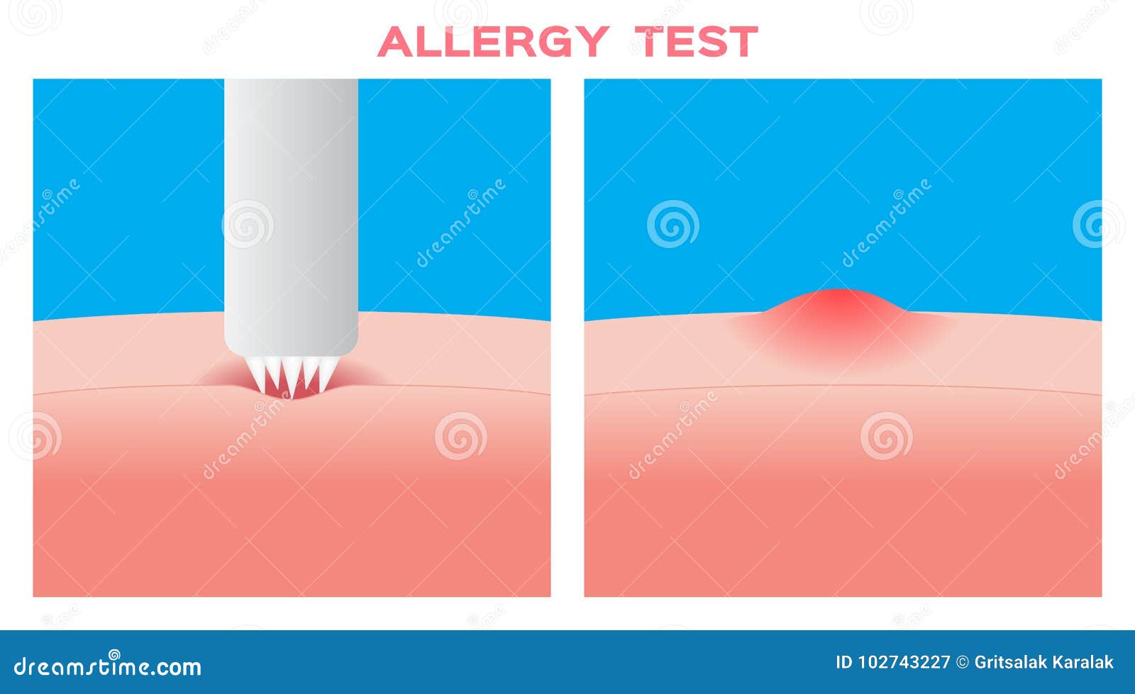 Allergy Test. Doctor Holds Pipette In Hand For Research. Cartoon Vector ...