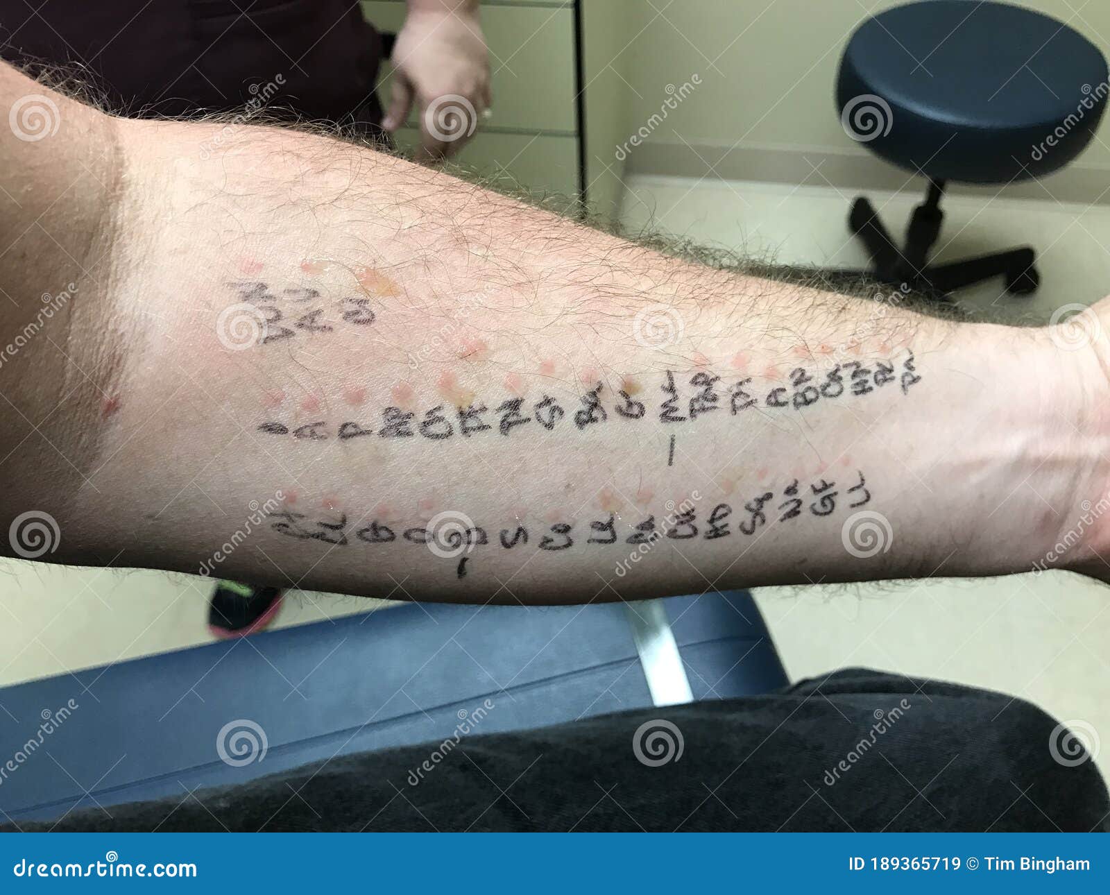 Allergy Testing on Arm stock image. Image of doctor - 189365719