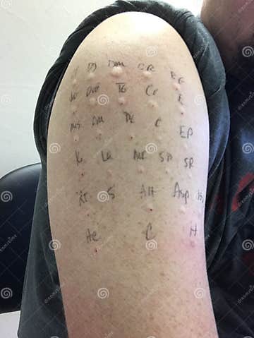 Allergy Testing Scratch Test on the Arm Stock Photo - Image of right ...