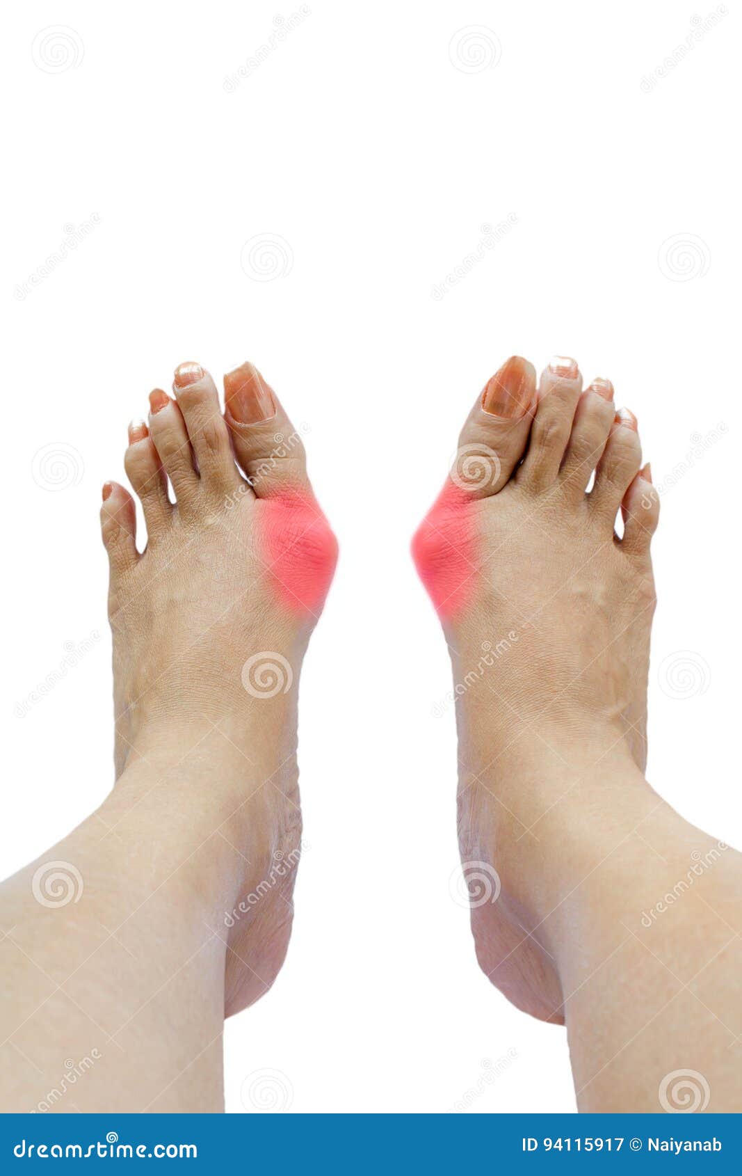 Alluce Valgo, Borsite Dell'alluce Nel Piede Immagine Stock - Immagine ...