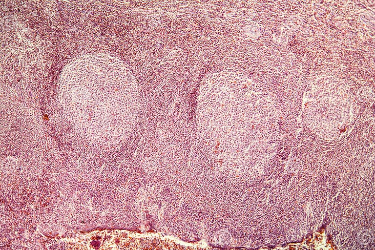 Almond Tonsils in Cross Section Stock Image - Image of tonsillitis ...