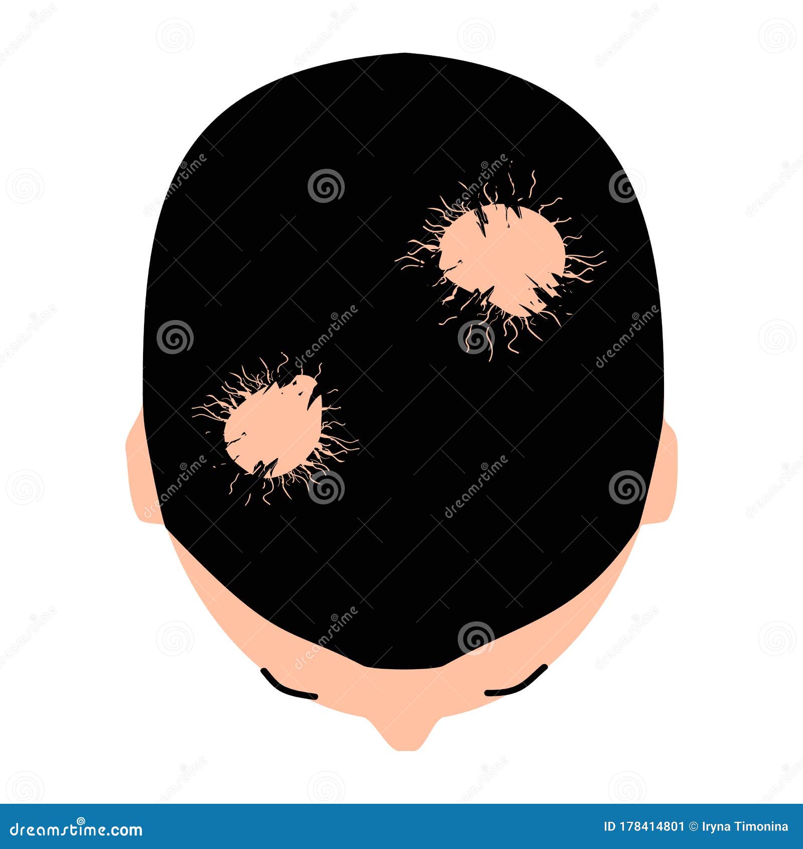 Alopecia Hair Loss Balding Process Cross Section Anatomical
