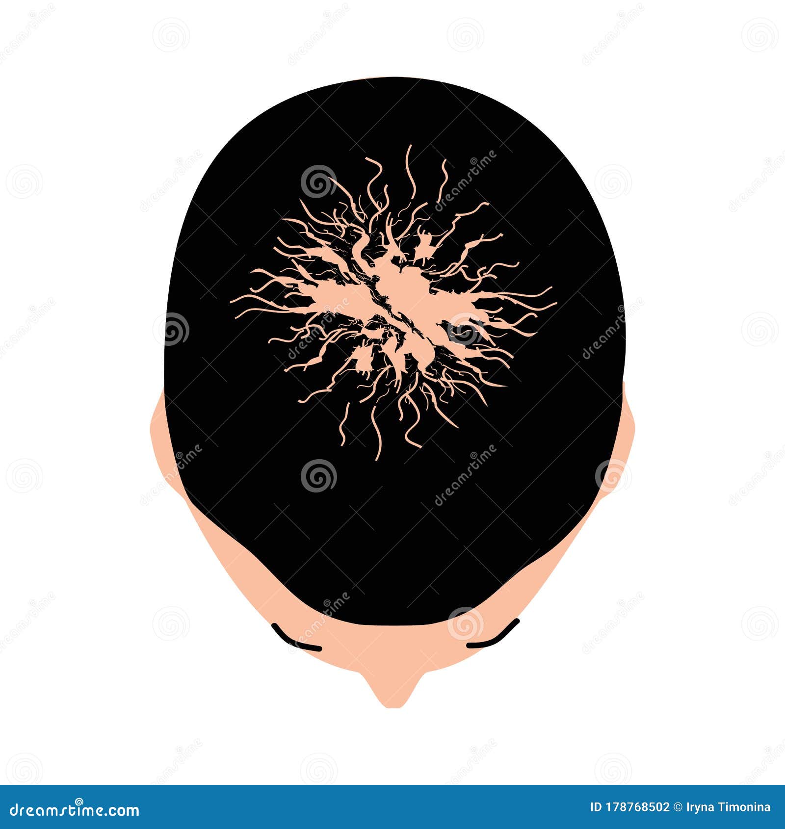 Alopecia Hair Loss Balding Process Cross Section Anatomical
