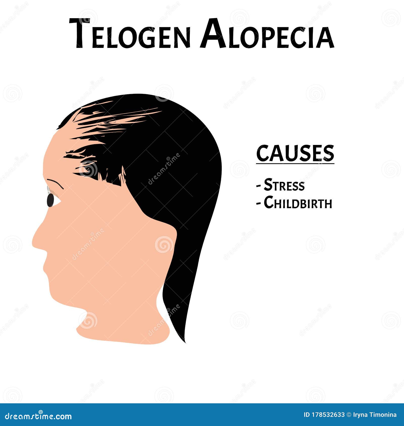 Alopecia Hair Loss Balding Process Cross Section Anatomical