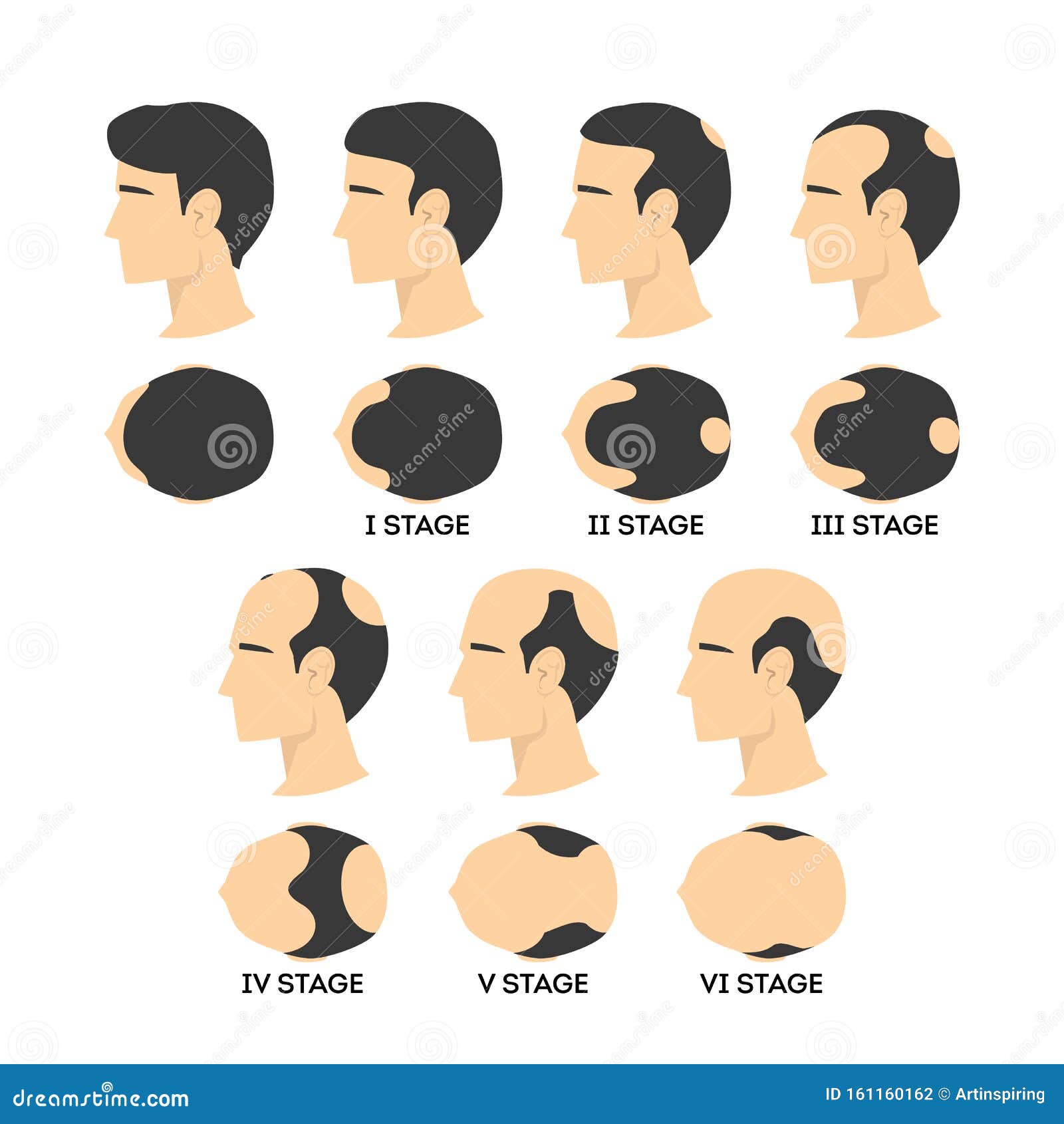 Alopecia Stages Set Hair Loss Balding Process Stock Vector