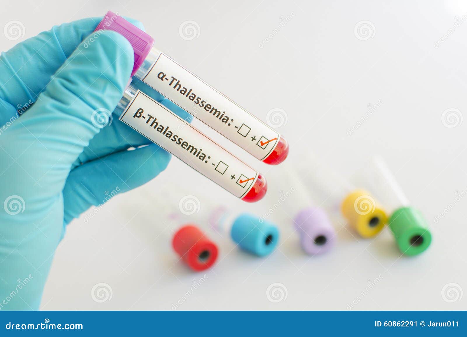 Alpha and Beta Thalassemia Blood Sample Stock Image - Image of disease ...