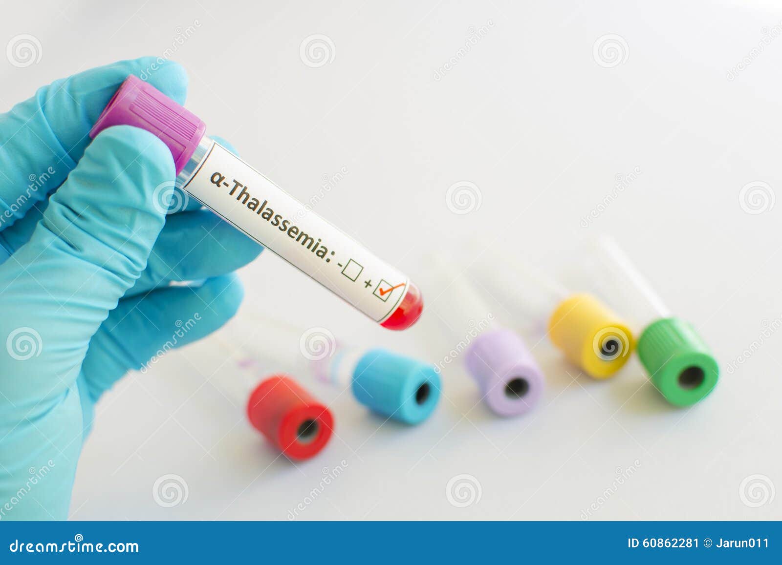 Thalassemia Blood Smear Abnormal Red Blood Cells Morphology. Stock ...