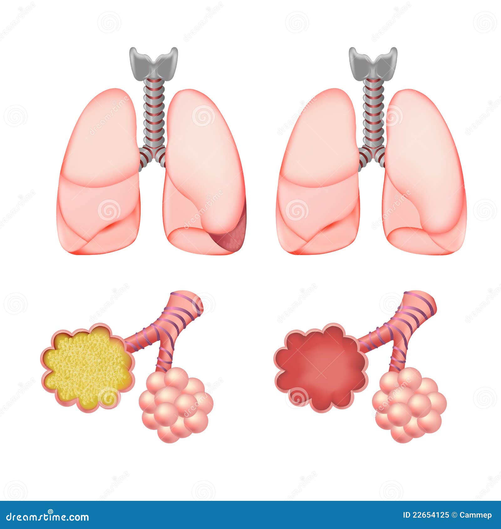 Alveoli in Lungs Set stock vector. Illustration of cavity - 22654125