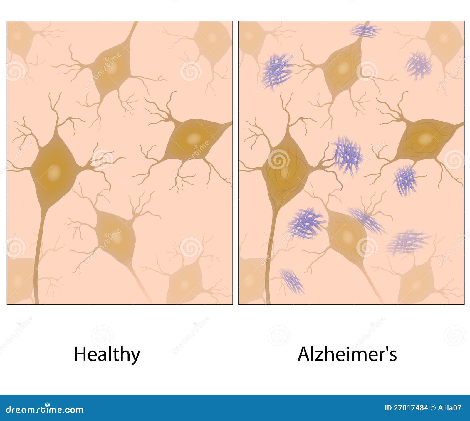 Alzheimer Disease Brain Tissue Stock Vector - Illustration of loss ...