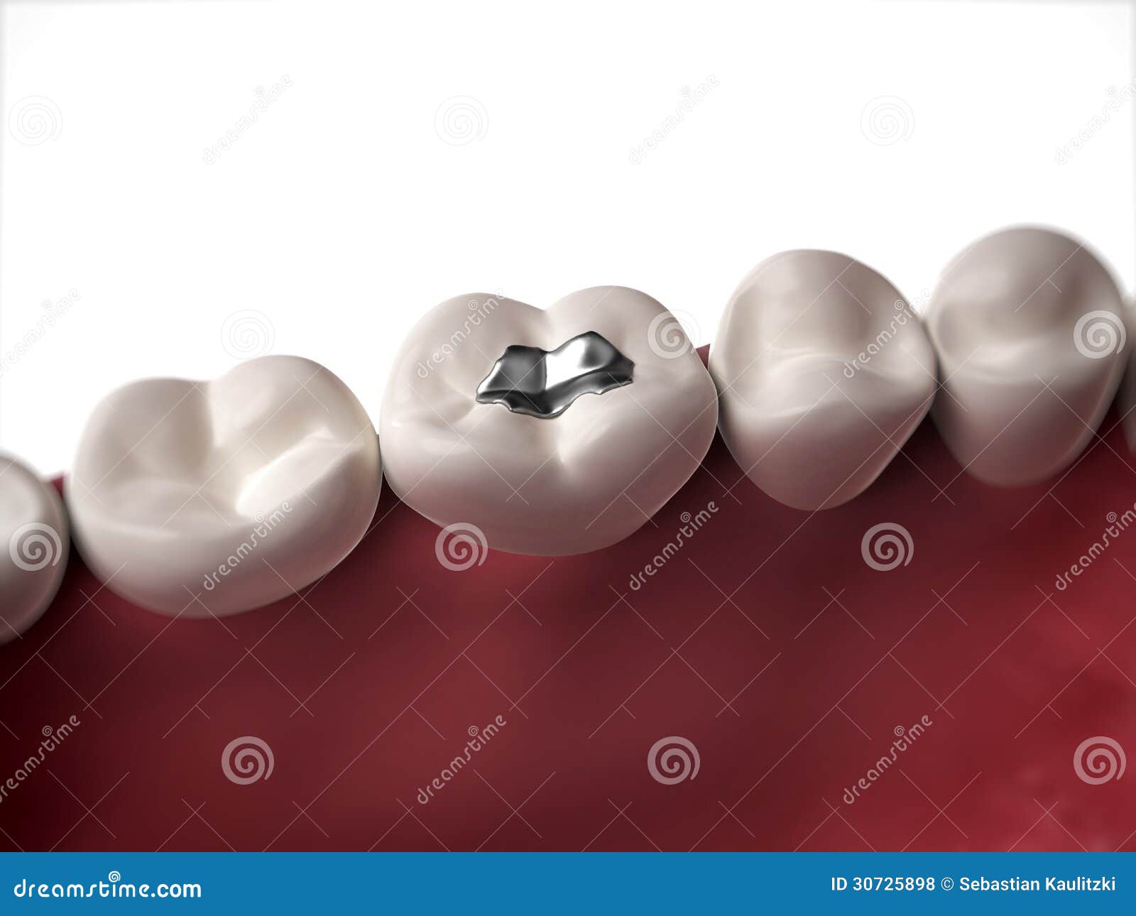 Amalgam filling stock illustration. Illustration of anatomy - 30725898