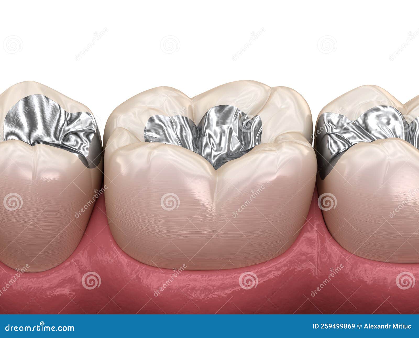 Amalgam Restoration. Medically Accurate 3D Animation of Dental Concept ...