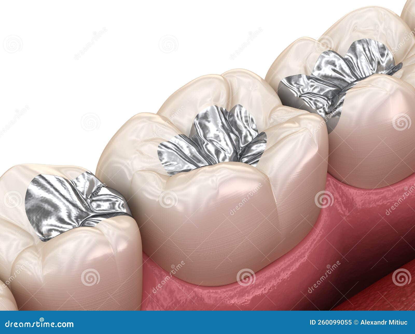 Amalgam Restoration. Medically Accurate 3D Animation of Dental Concept ...