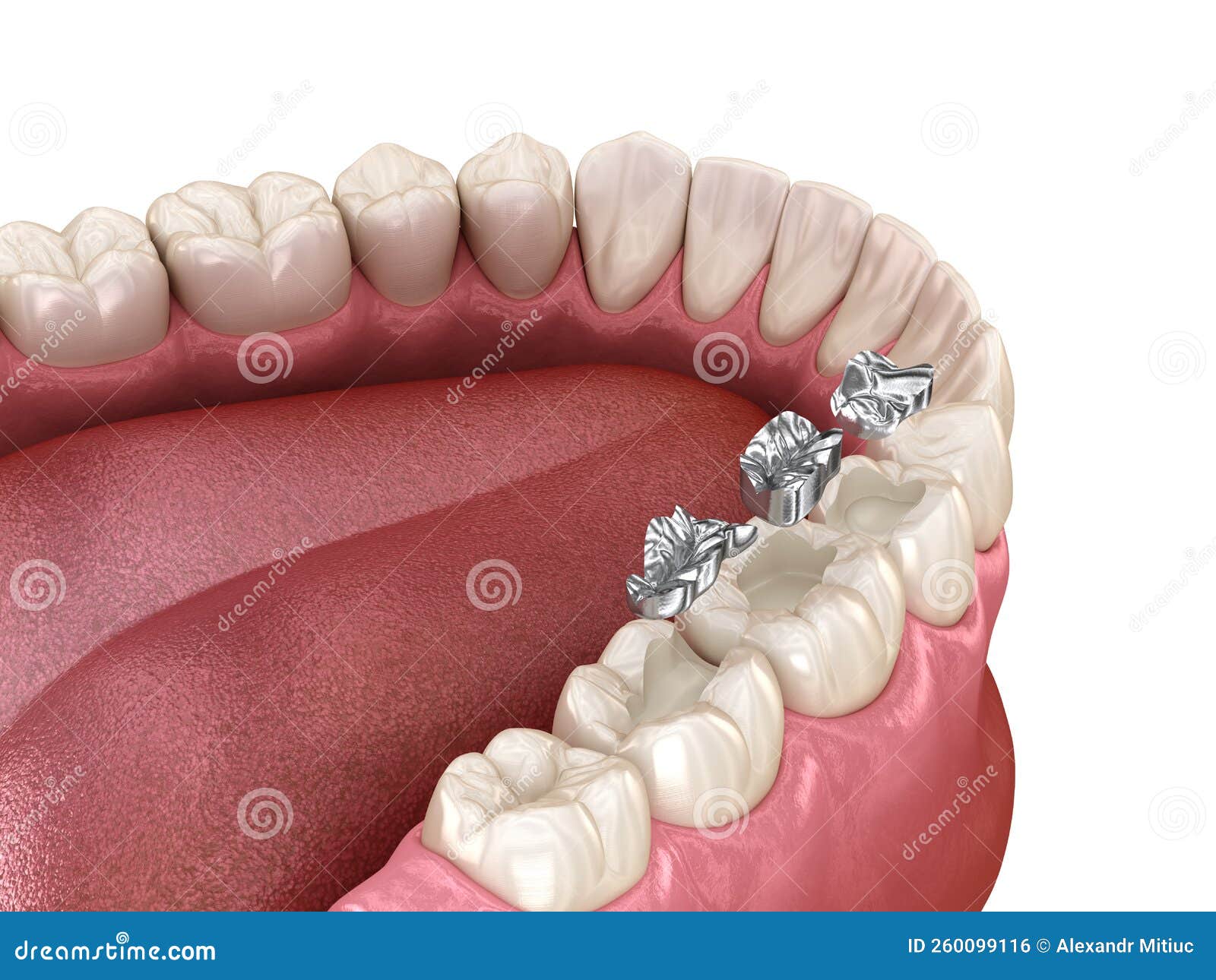 Amalgam Restoration. Medically Accurate 3D Animation Of Dental Concept ...