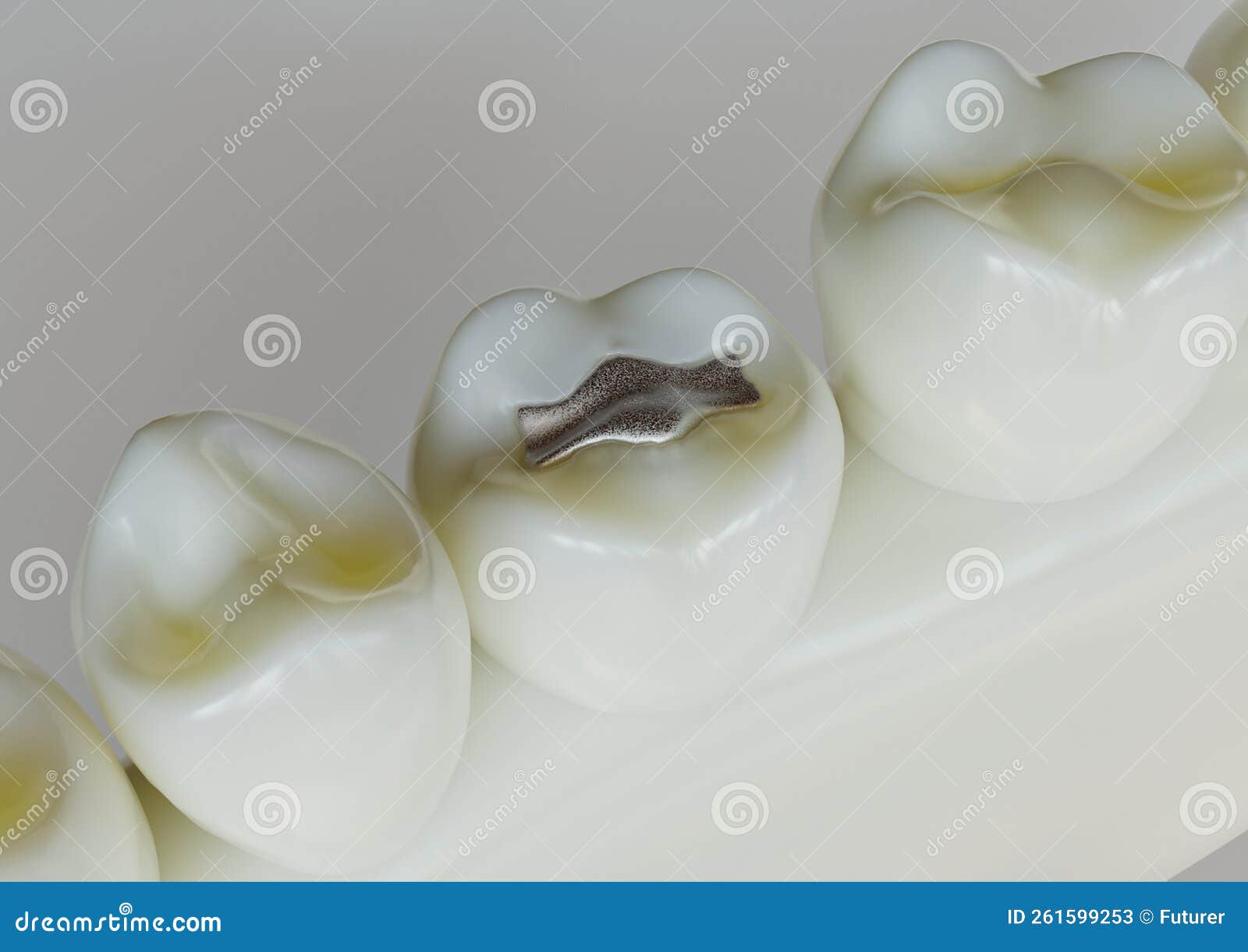 Fissure Preparation For Fillings Placement, Medically Accurate 3D ...