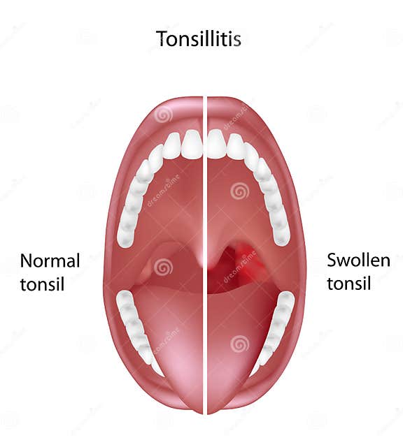 Amandelontsteking vector illustratie. Illustration of voorafgaand ...