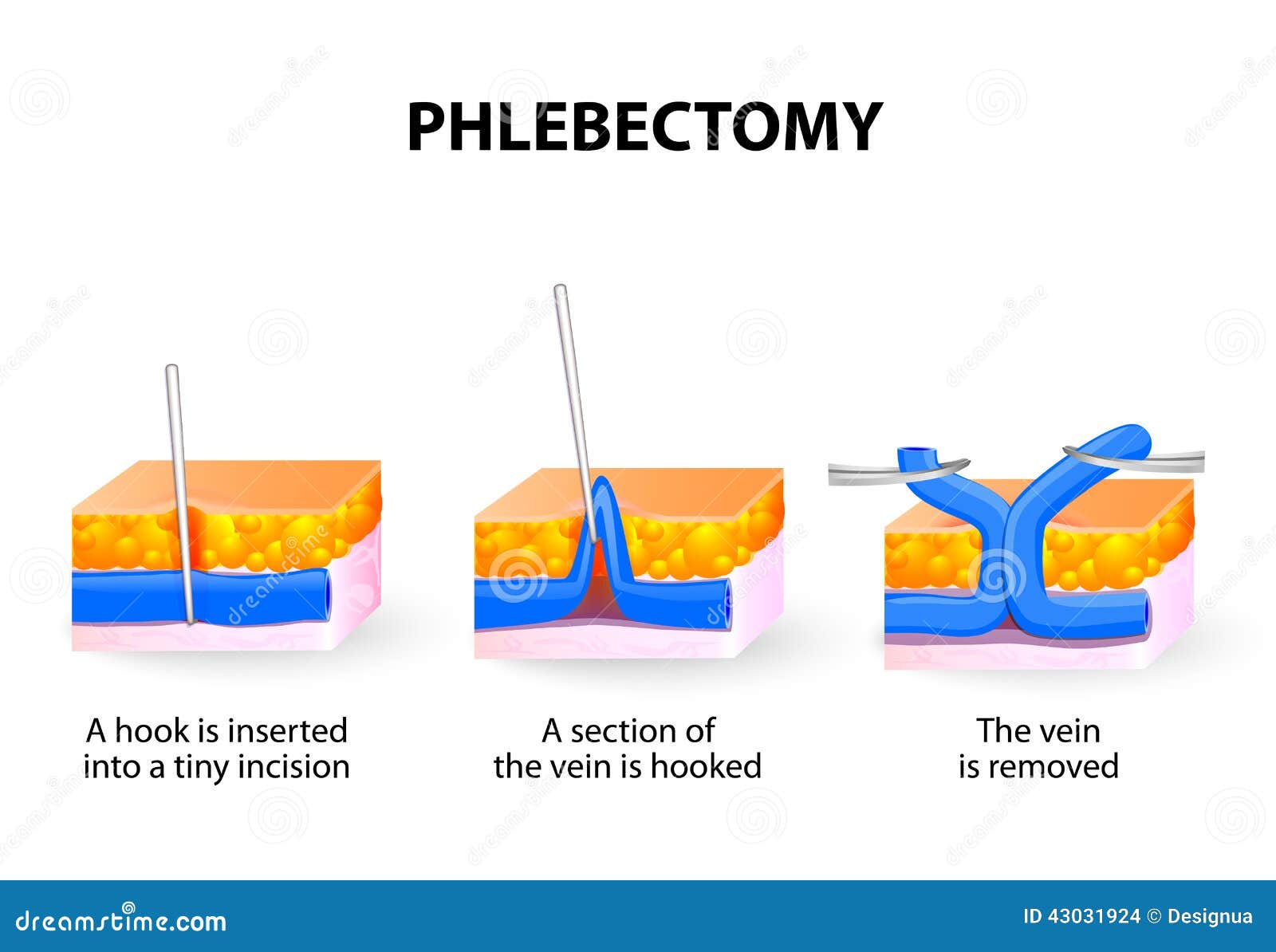 Ambulante Phlebectomy-Behandeling Vector Illustratie - Illustration of ...