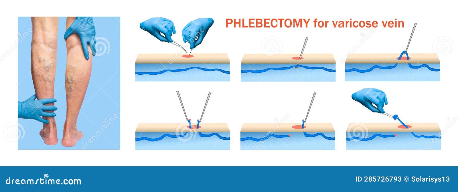Ambulatory Phlebectomy Treatment for Varicose Vein. Stock Image - Image ...