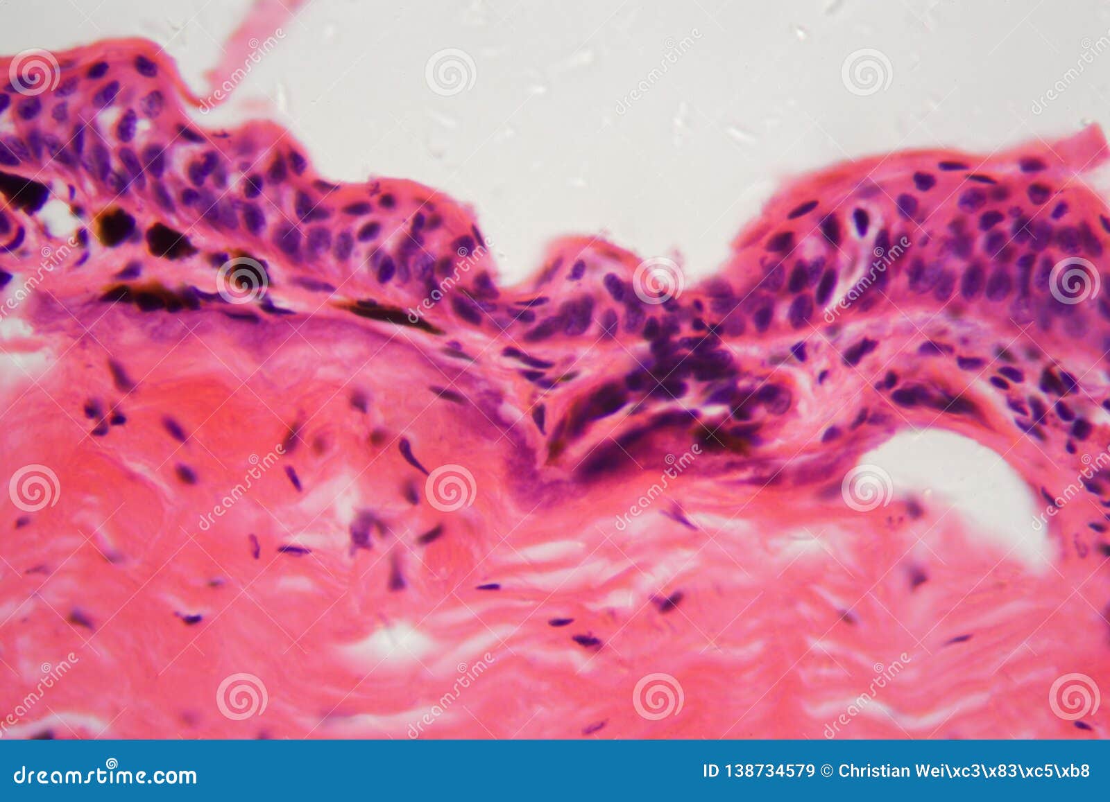 Skin Ulcer Histology