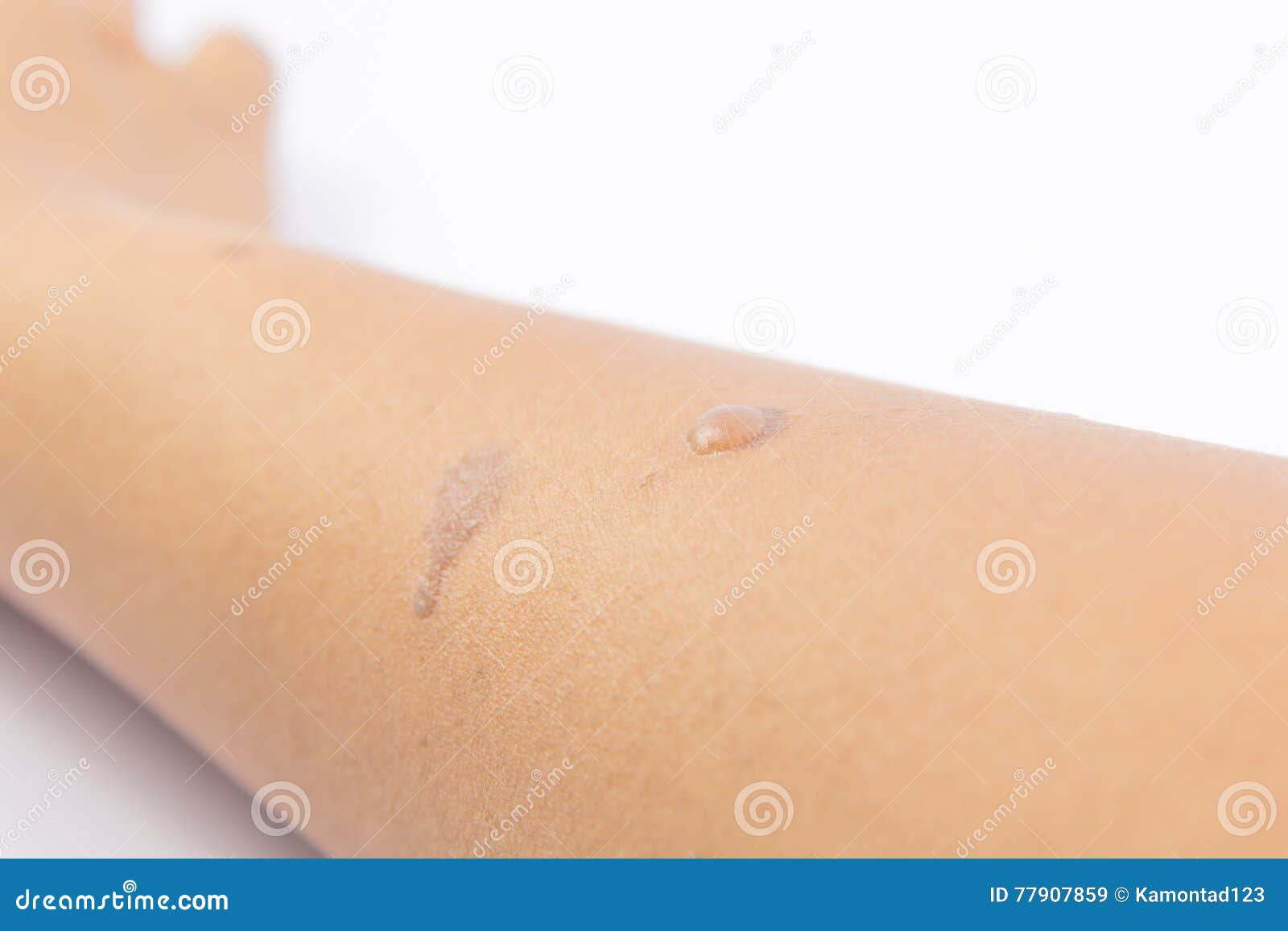 Ampollas En El Brazo De La Piel Imagen de archivo - Imagen de escalde ...