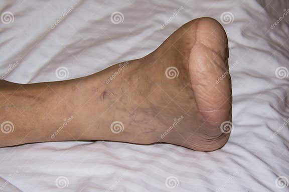 Amputated stock image. Image of skin, health, scar, hospital - 57291339