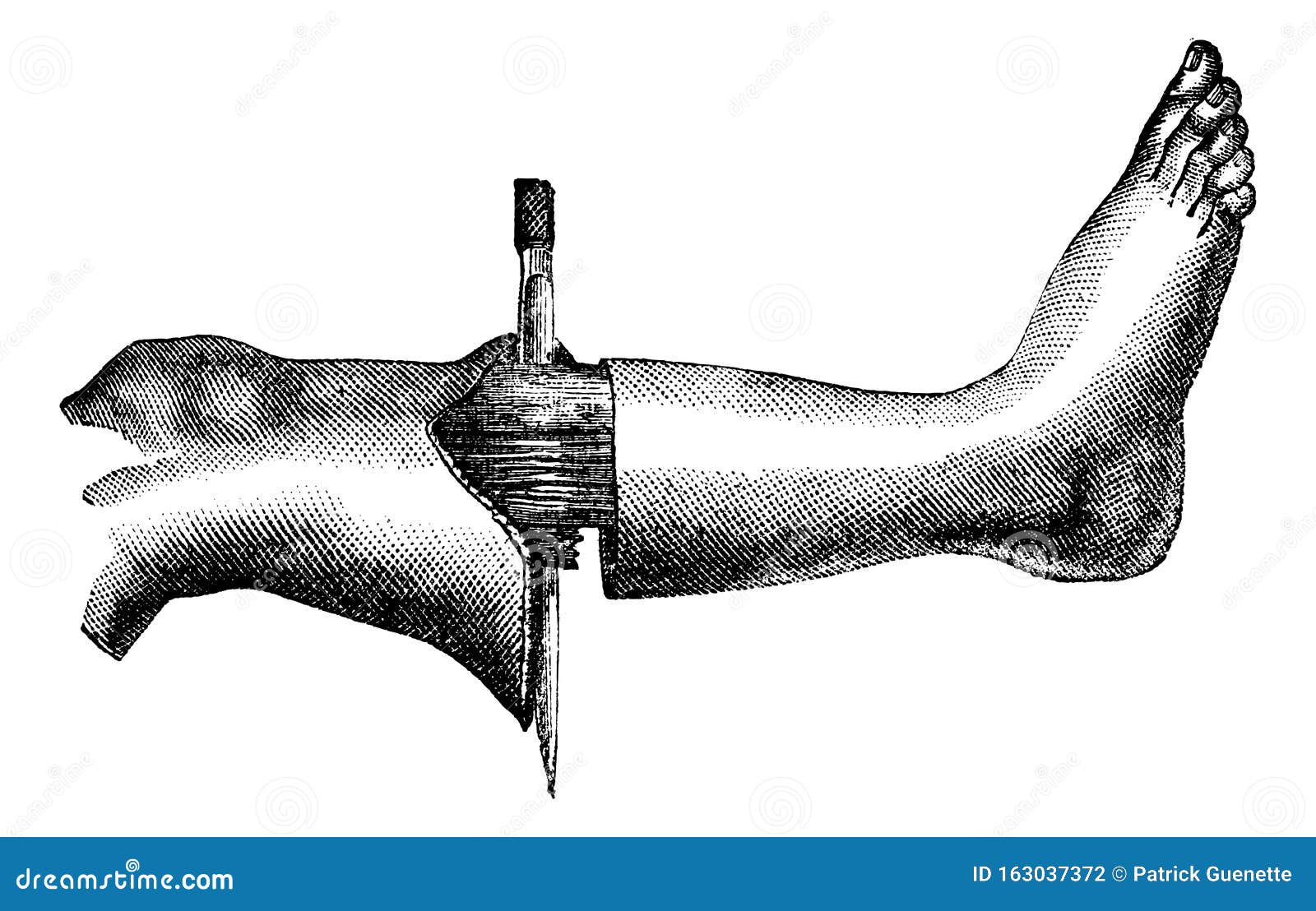 Amputation of the Leg by the Method Has Two Flaps Circular Incision and ...