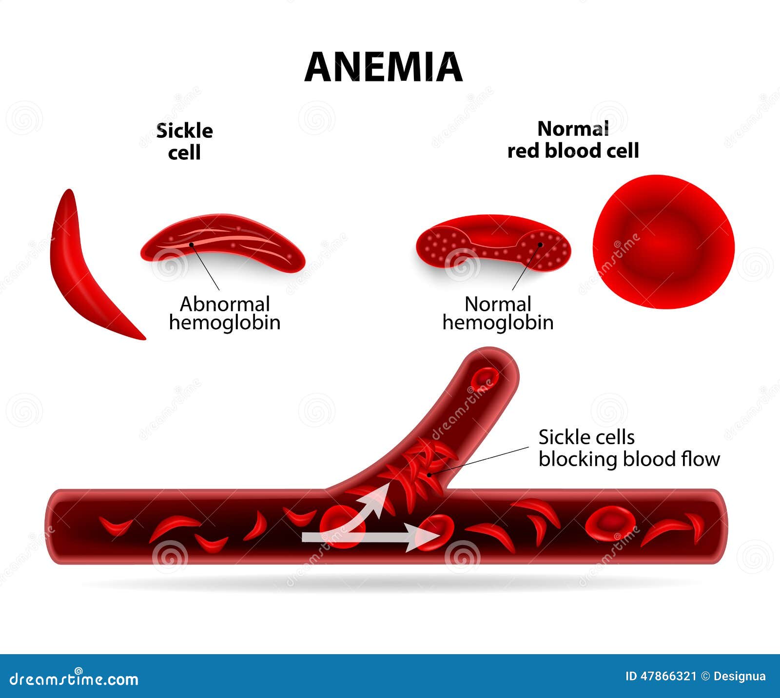 Anémie illustration de vecteur. Illustration du insuffisance - 47866321