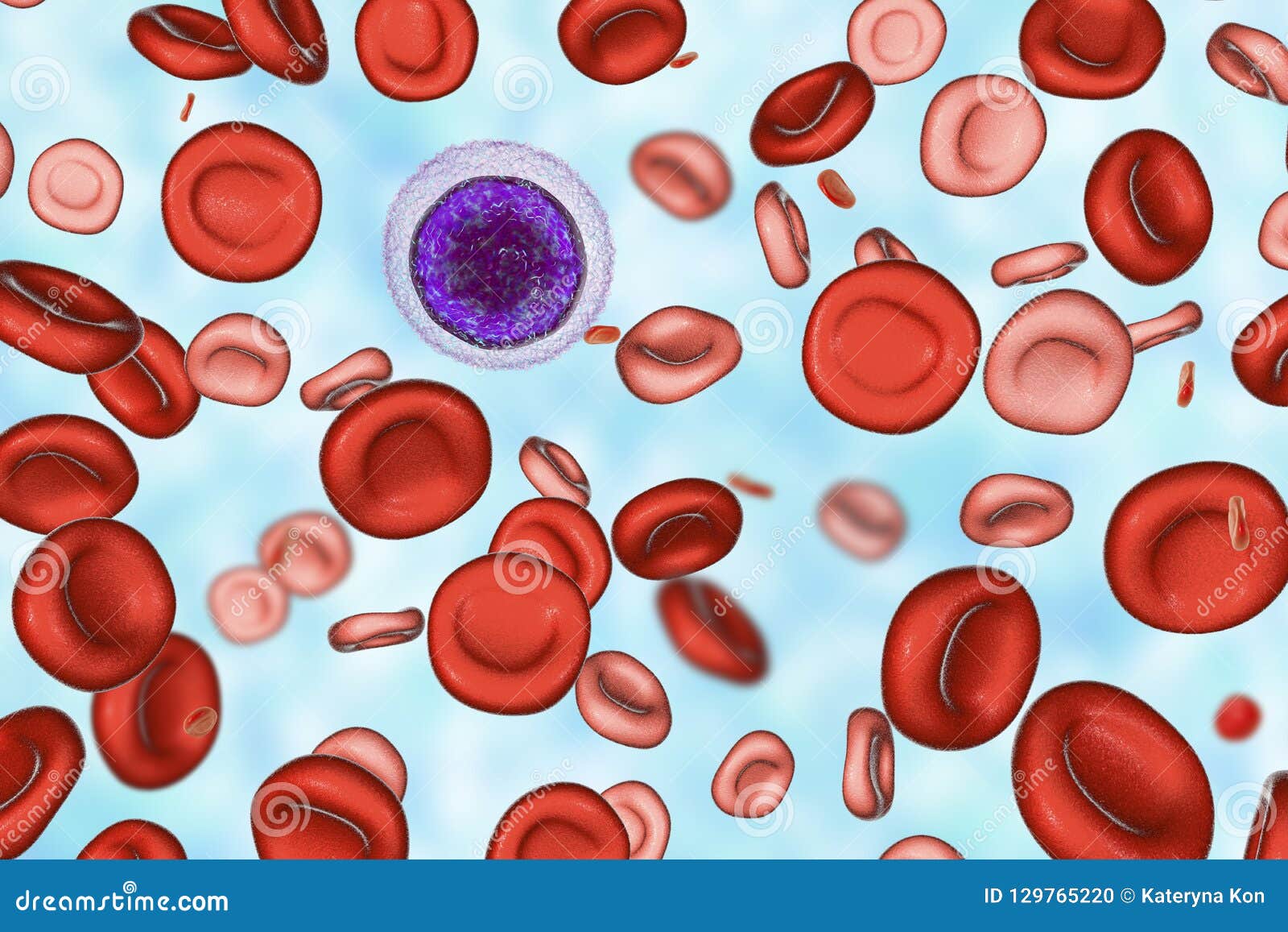 Anémie ferriprive photo stock. Image du sang, erythrocytes - 129765220