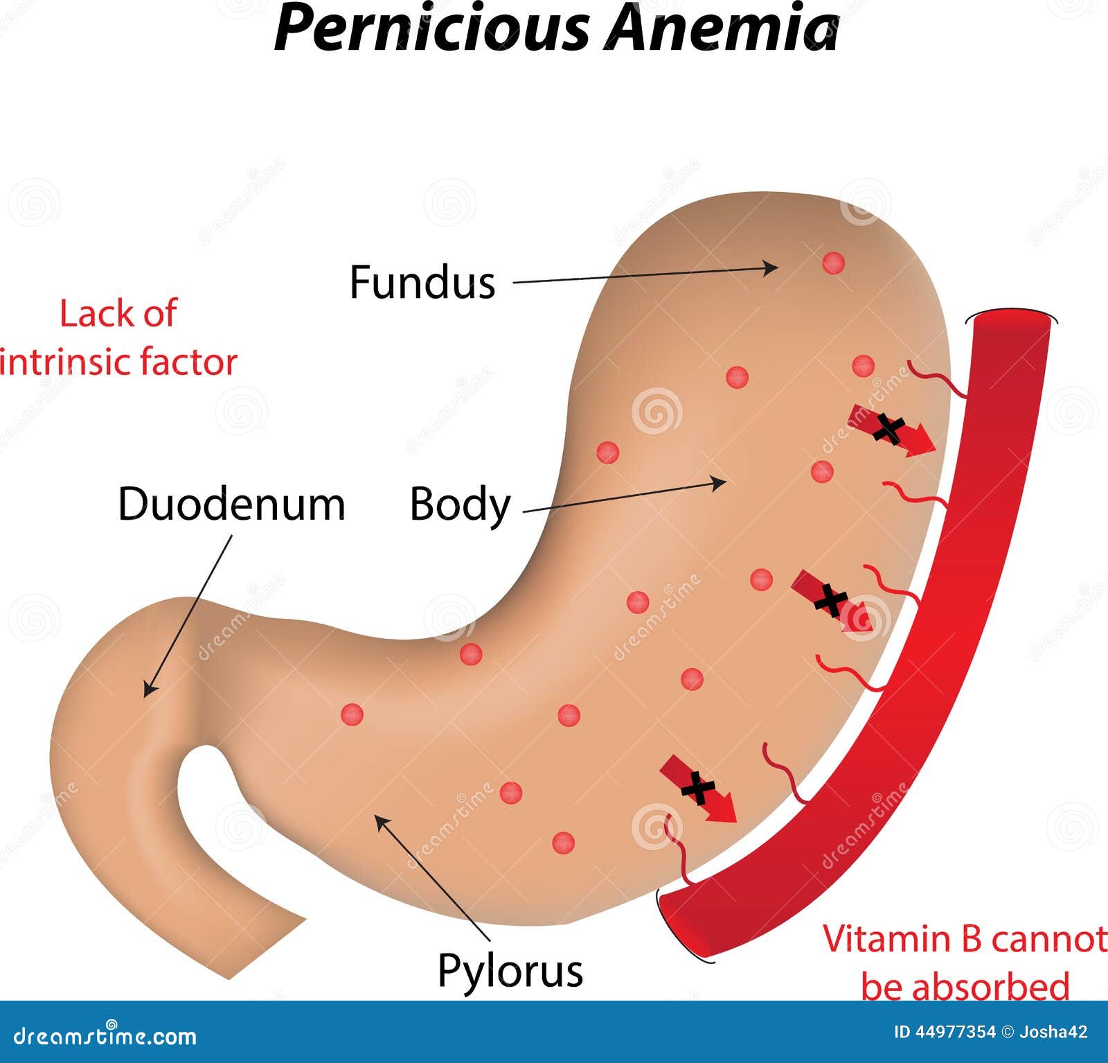 Anémie pernicieuse illustration de vecteur. Illustration du pathologie ...