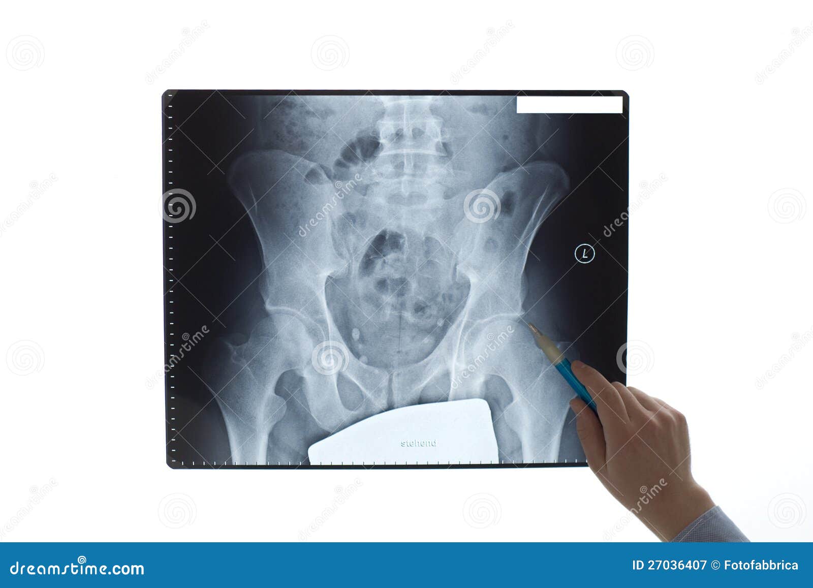 Analyser L'image De Rayon X Image stock - Image du docteur, bassin ...